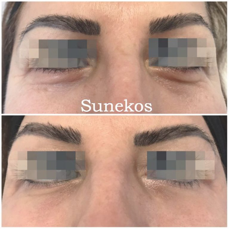 Få sunekos behandling | Din skønhedsklinik på Østerbro